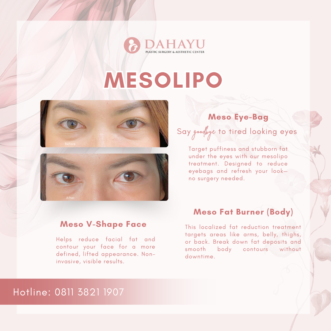 Mesolipo Treatment - Puri Bunda Hospital