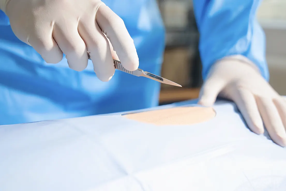 Local Flap Reconstruction - Puri Bunda Hospital